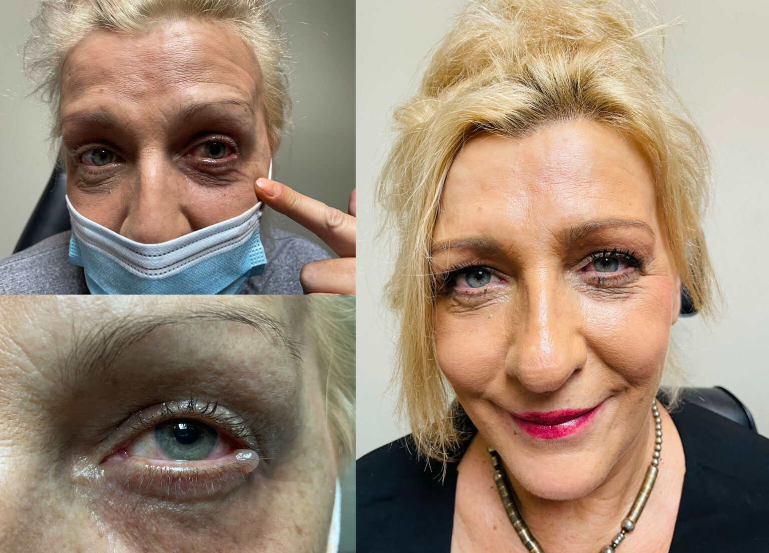 Chalazion - Gulani Vision Institute