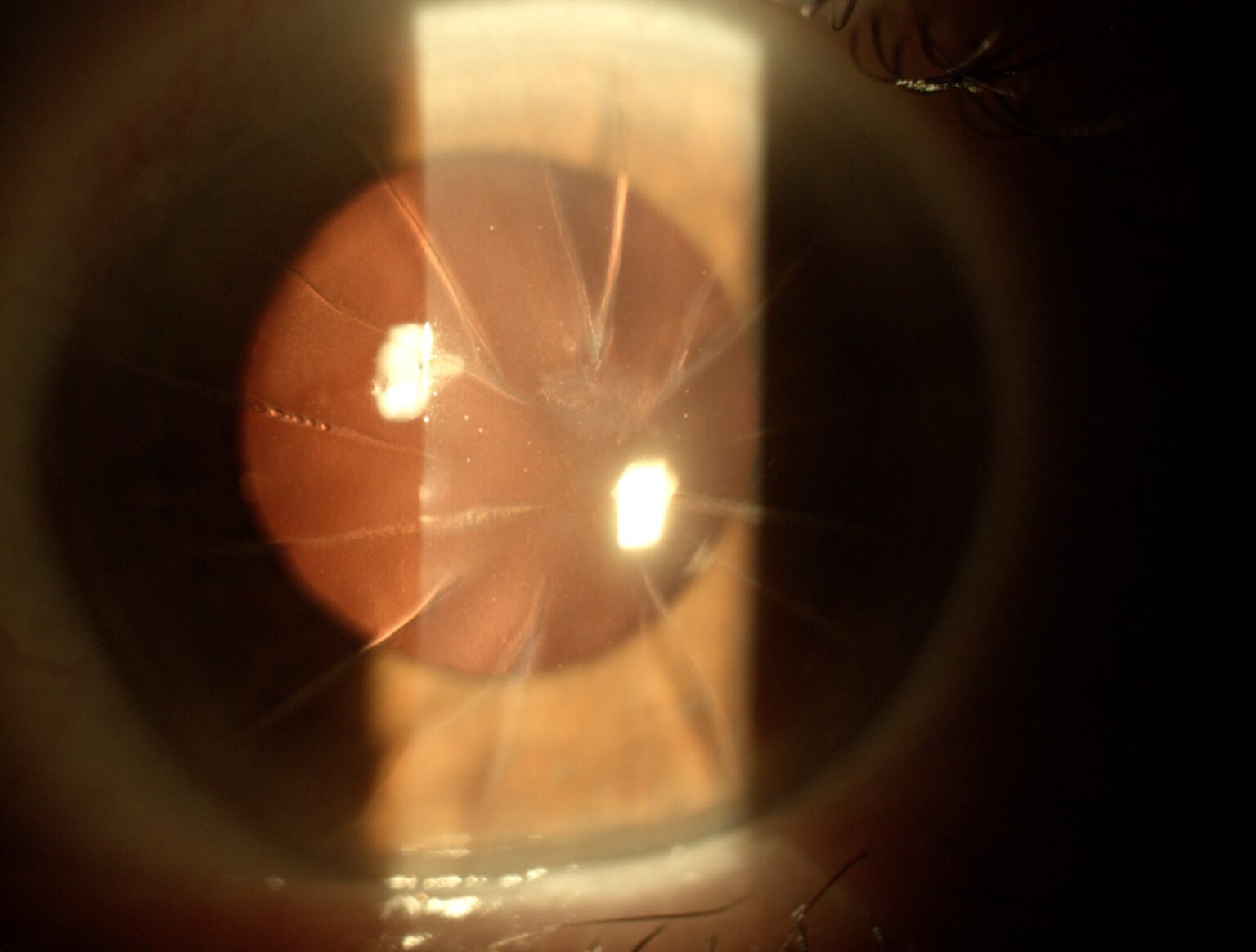 RK Surgery / Radial Keratotomy Correction | Gulani Vision Institute