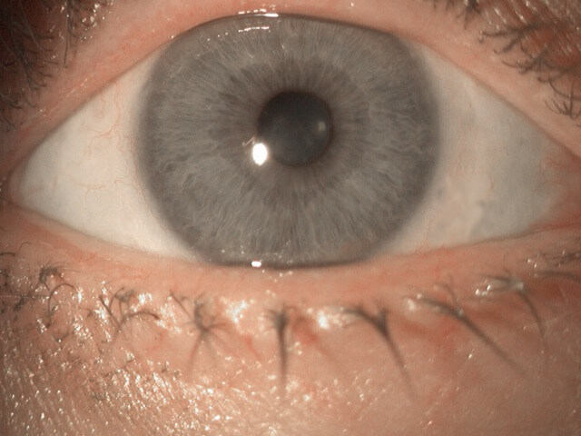 Pterygium Gallery Jacksonville | Gulani Vision Institute