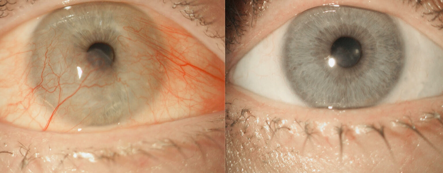 Pterygium & Pinguecula Surgery | Dr. Arun Gulani’s SPARKLE™ Technique