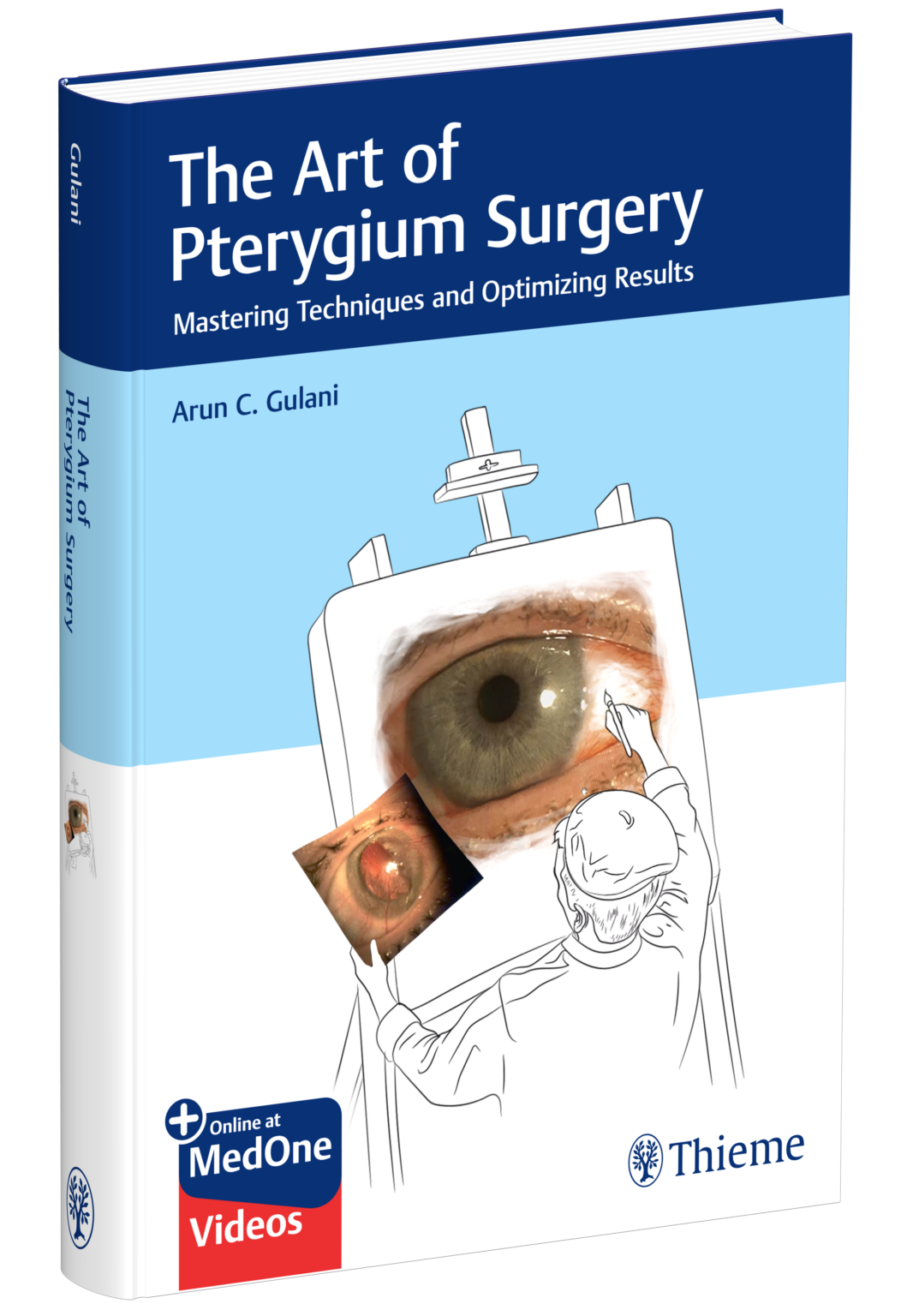Pterygium & Pinguecula Surgery | Dr. Arun Gulani’s SPARKLE™ Technique