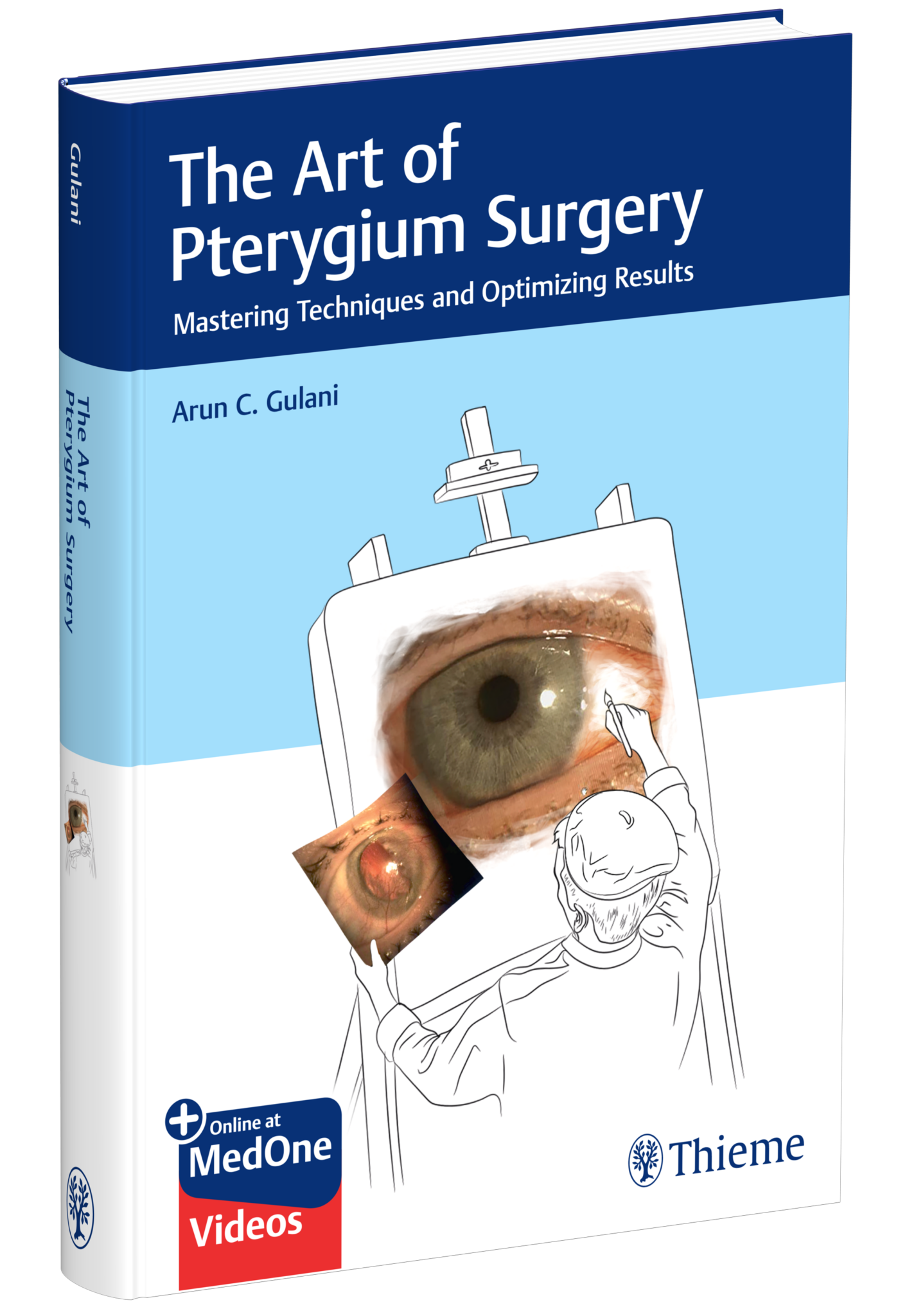 Pterygium & Pinguecula Surgery | Dr. Arun Gulani’s SPARKLE™ Technique