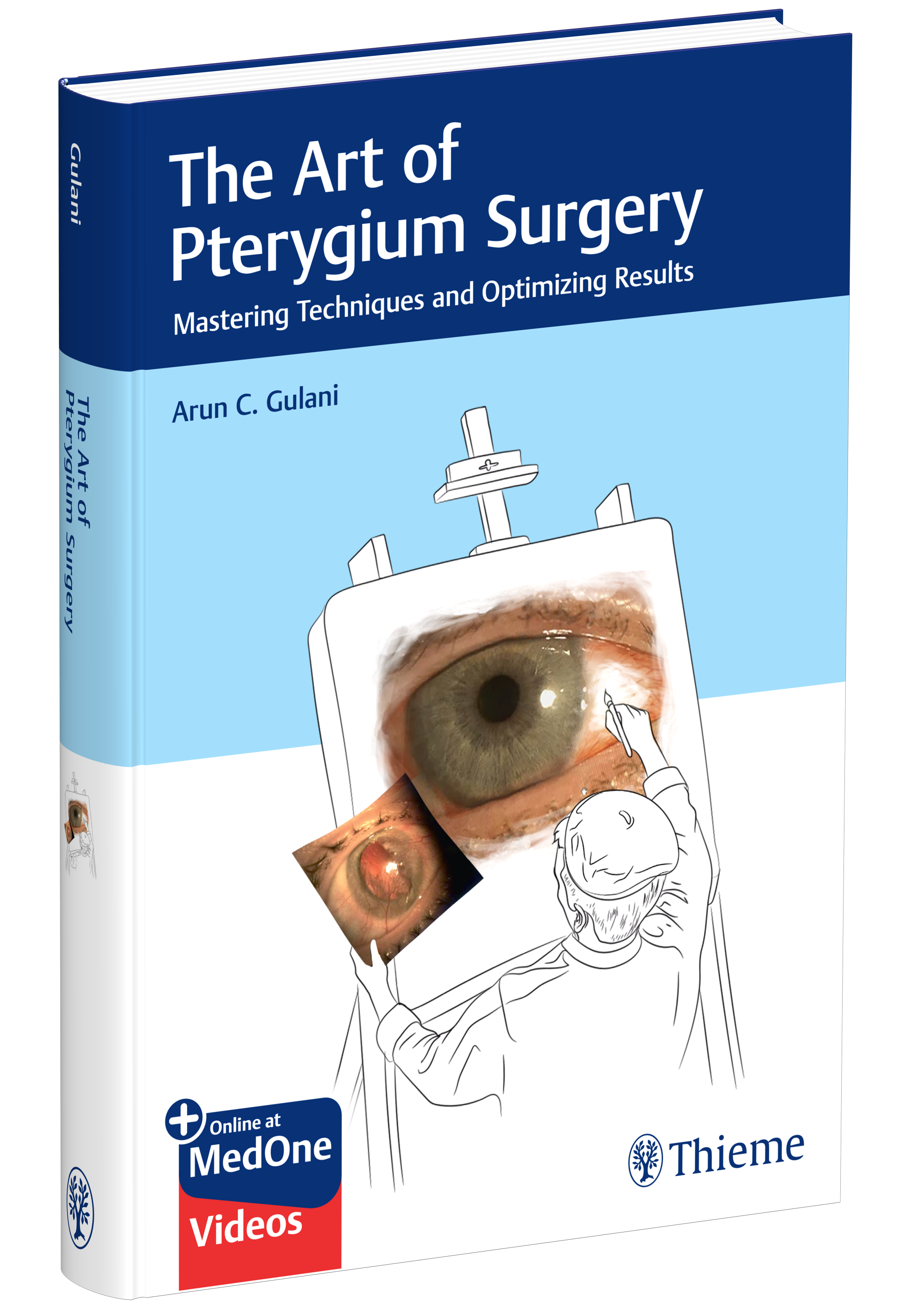 Pterygium & Pinguecula Surgery | Dr. Arun Gulani’s SPARKLE™ Technique