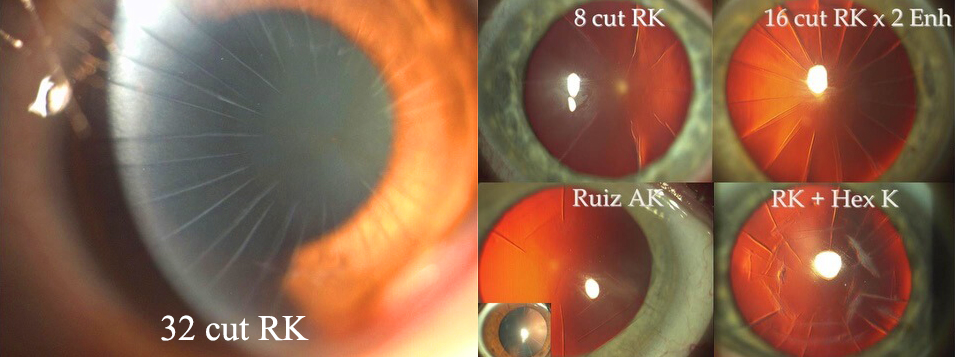 Rk Surgery Radial Keratotomy Correction Gulani Vision Institute