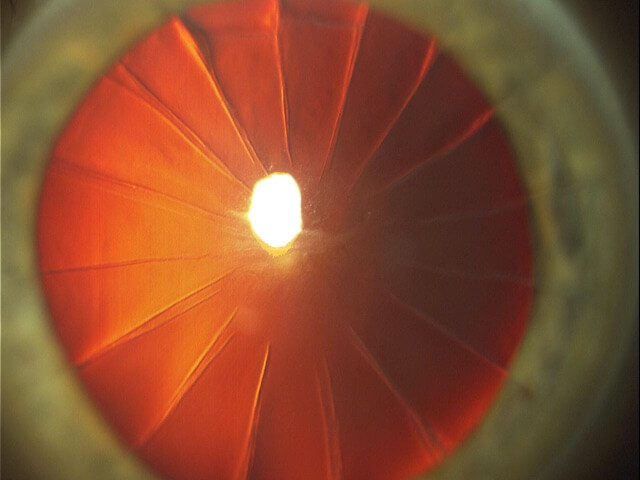 Restoring Vision in Radial Keratotomy Patients with Cataracts
