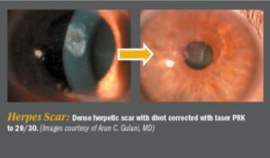 Corneal Scar Correction Jacksonville | Gulani Vision Institute