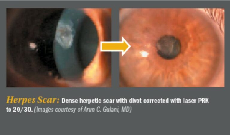 World’s Leading Expert in Corneal Scar Correction – Dr. Gulani in ...