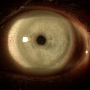 Corneal Scar Gallery Jacksonville - Gulani Vision Institute
