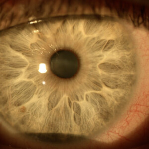 Corneal Scar Gallery Jacksonville - Gulani Vision Institute