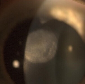 Corneal Scar Gallery Jacksonville - Gulani Vision Institute