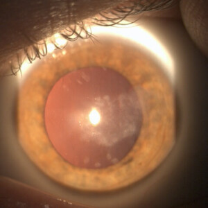 Corneal Scar Gallery Jacksonville - Gulani Vision Institute