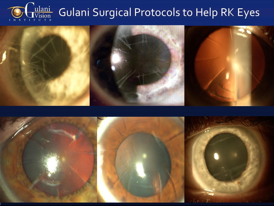 Radial Keratotomy Repair: Restoring Vision After Radial Keratotomy (RK)