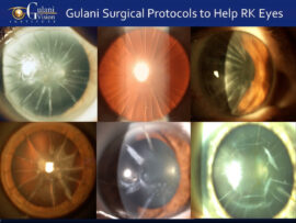 Radial Keratotomy Repair: Restoring Vision After Radial Keratotomy (RK)